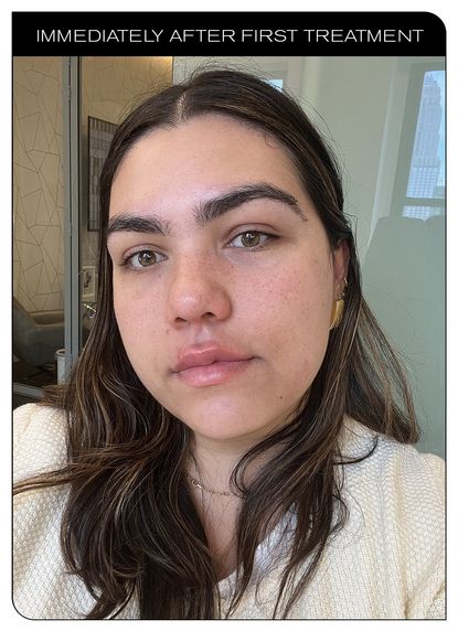 Lip Filler Dissolver: What It Is and What to Expect | Who What Wear