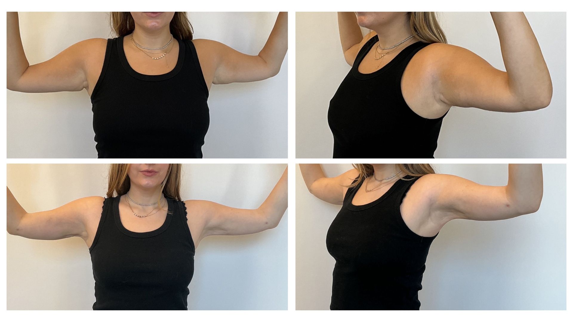 Arm Liposuction and Renuvion Transformed My “Ozempic Arms” | Marie Claire