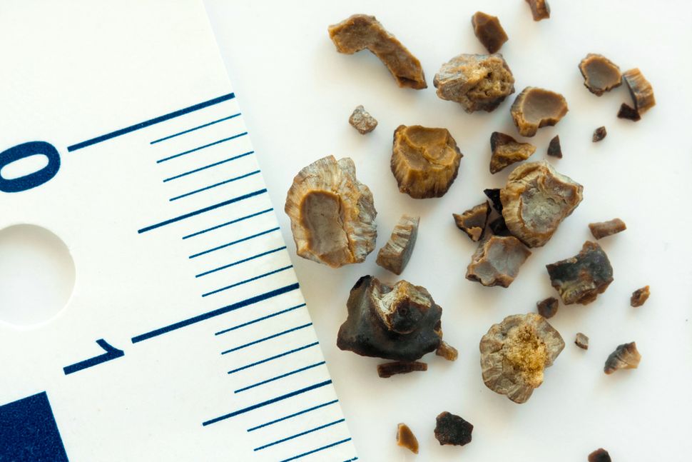 Kidney Stones: Causes, Symptoms & Treatment | Live Science
