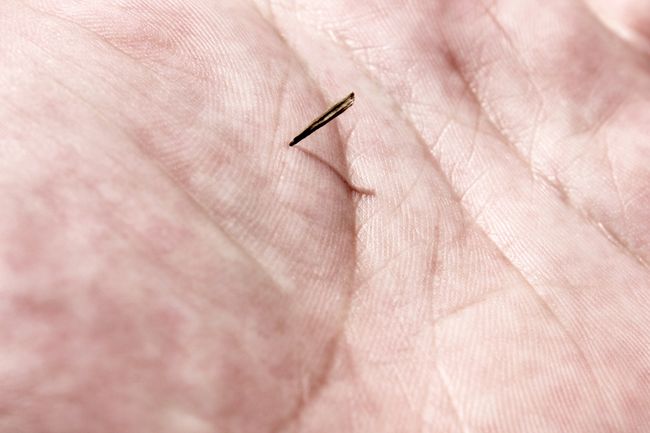 What happens if you don’t take out a splinter? | Live Science