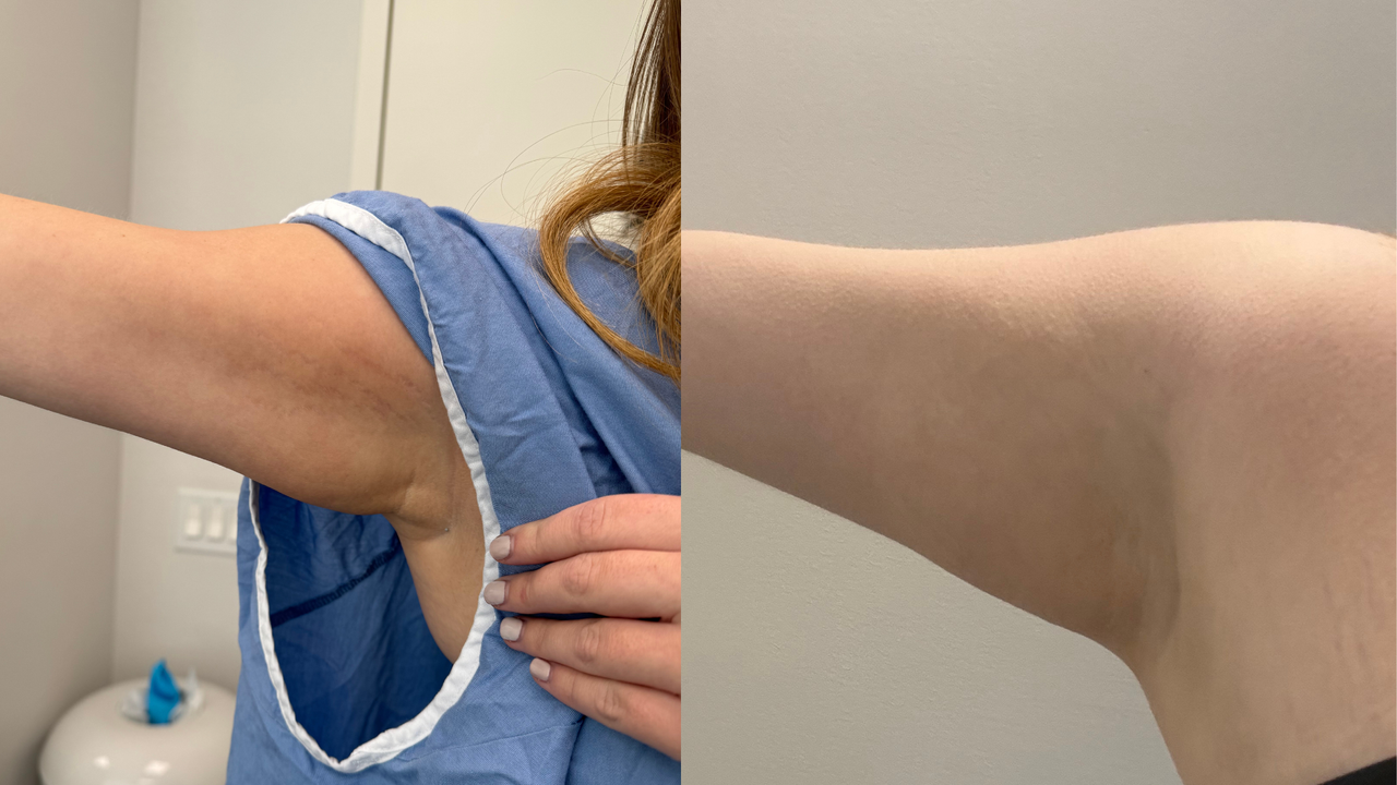 Sofwave's Hot Ultrasound Waves Tightened My Loose Arm Skin | Marie Claire