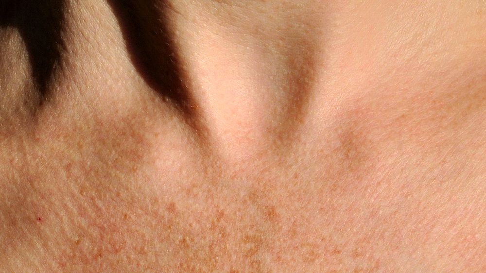 Exactly How to Treat Melasma, According to Dermatologists | Marie Claire