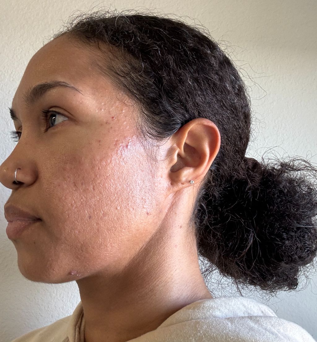 A Beauty Editor Reviews Cellstory Liquid Micro-Needling | Who What Wear