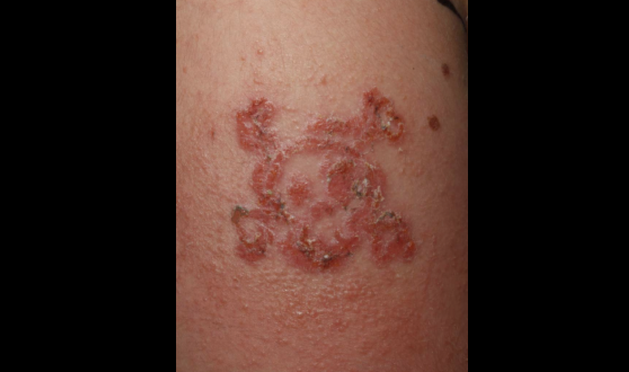 Black Henna Tattoos Can Cause Severe Skin Reactions, Case Shows | Live ...