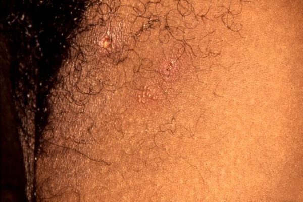 Herpes Pictures & Symptoms of Herpes Simplex | Live Science