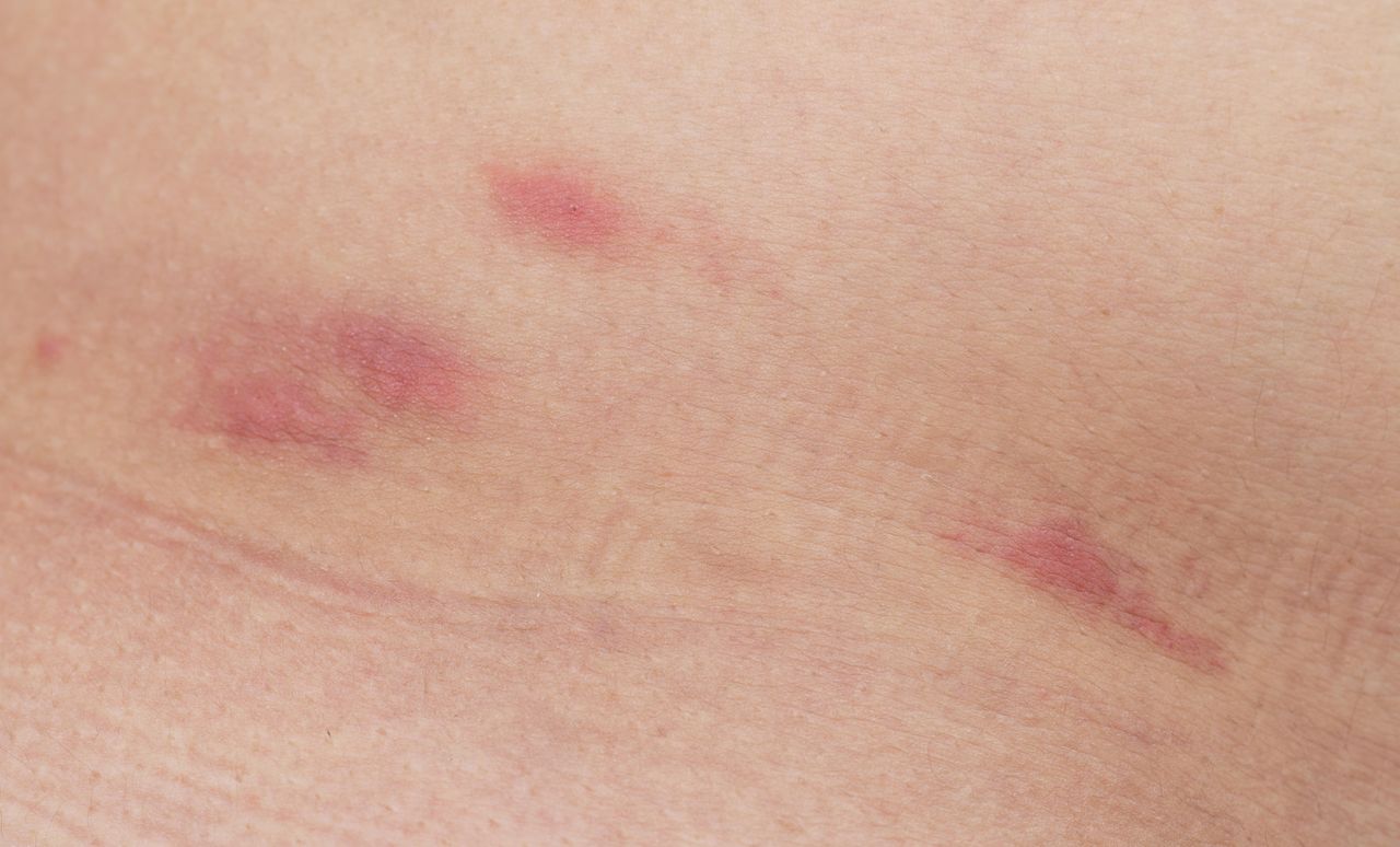 What are the different types of insect bites? | GoodtoKnow