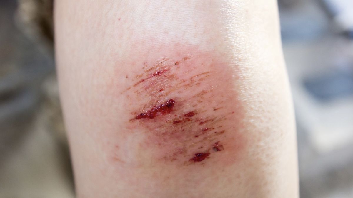 How to treat minor injuries during a run | Advnture