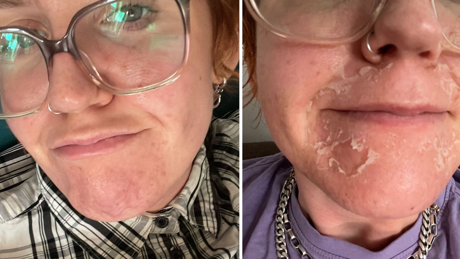 VI Peel review: What to expect and is it really worth it? | Woman & Home