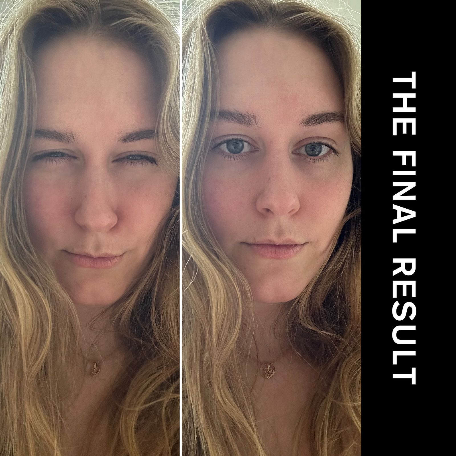 I Got Botox for the First Time—Here's What You Need to Know | Who What Wear
