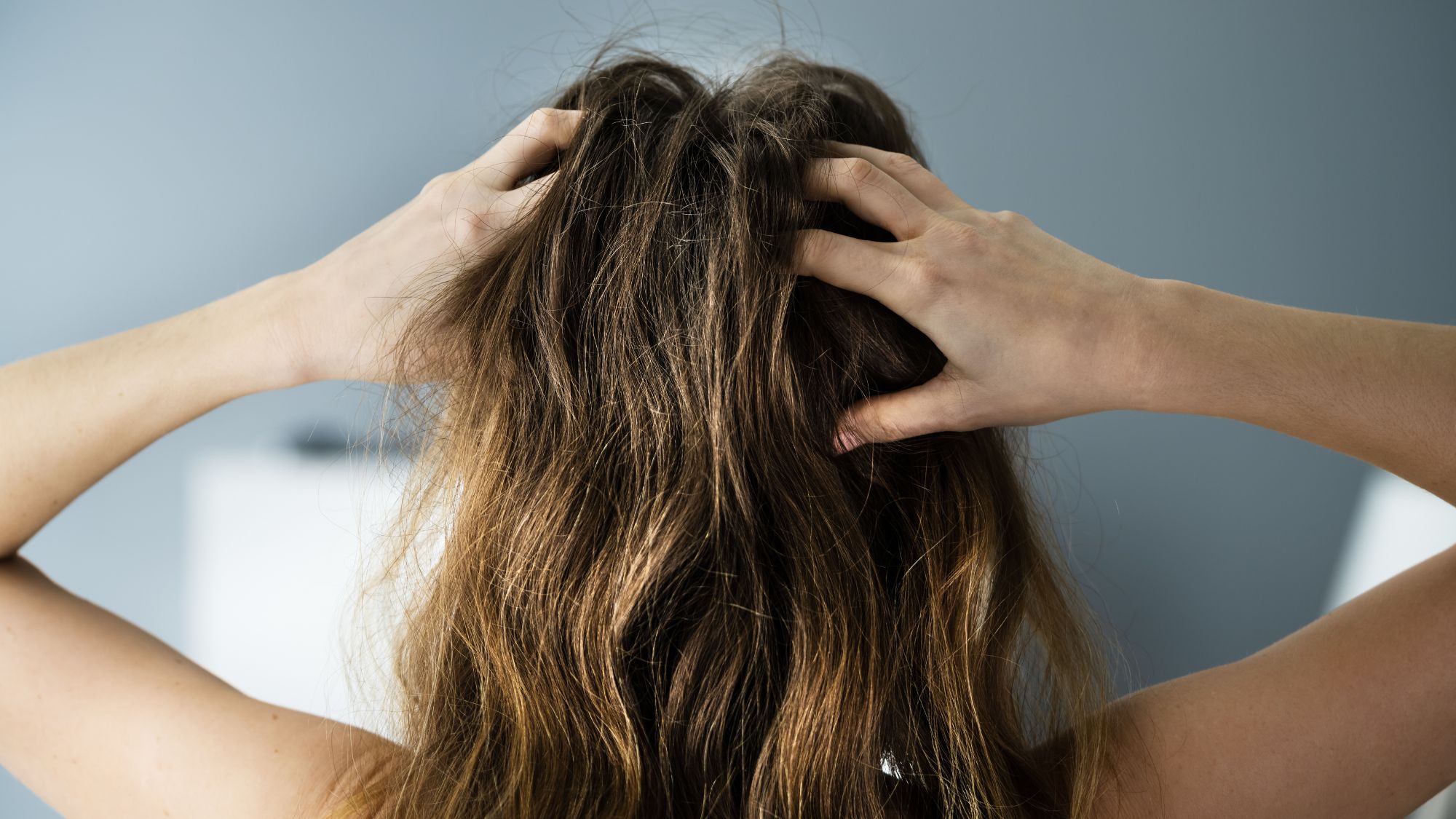 Hairline Psoriasis: How To Prevent & Treat The Condition | Marie Claire UK