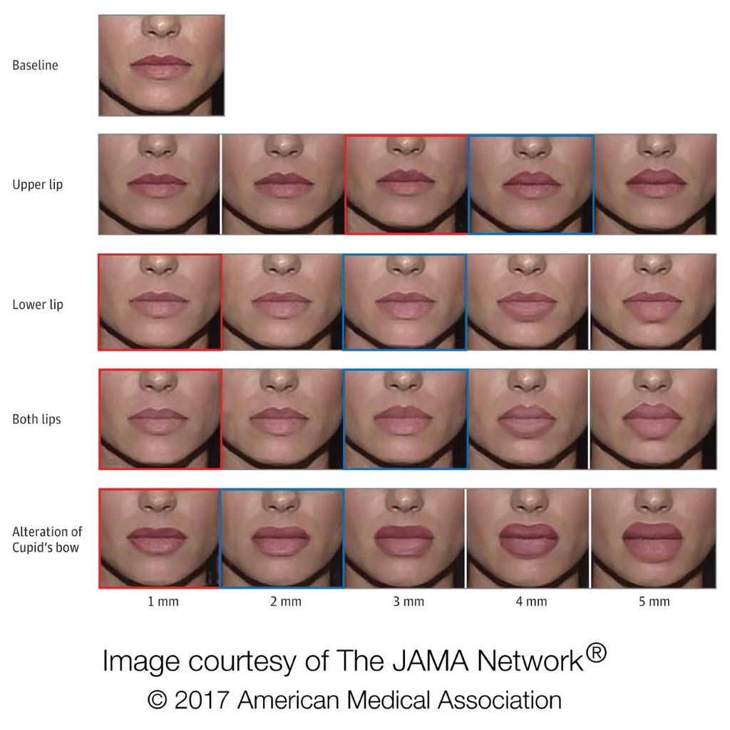 How to Tell If Someones Had Lip Injections - Signs of Lip Fillers ...