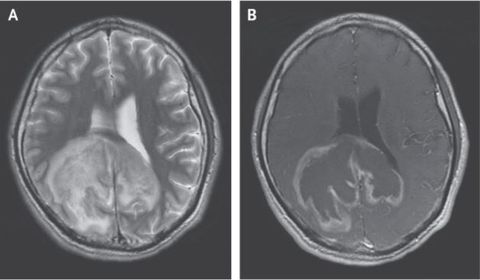 Man's Lurking Parasitic Infection 'Woke Up' In His Brain | Live Science