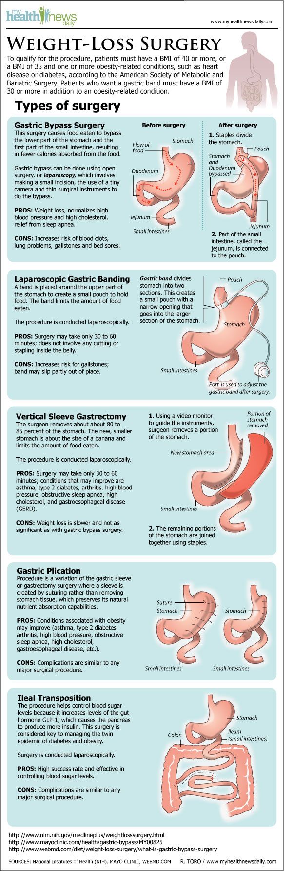 Infographic: Types of Weight Loss Surgery | Live Science
