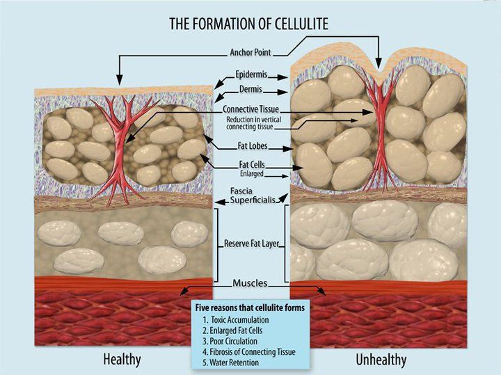 How to get rid of cellulite: 15 expert tips from dermatologists and ...