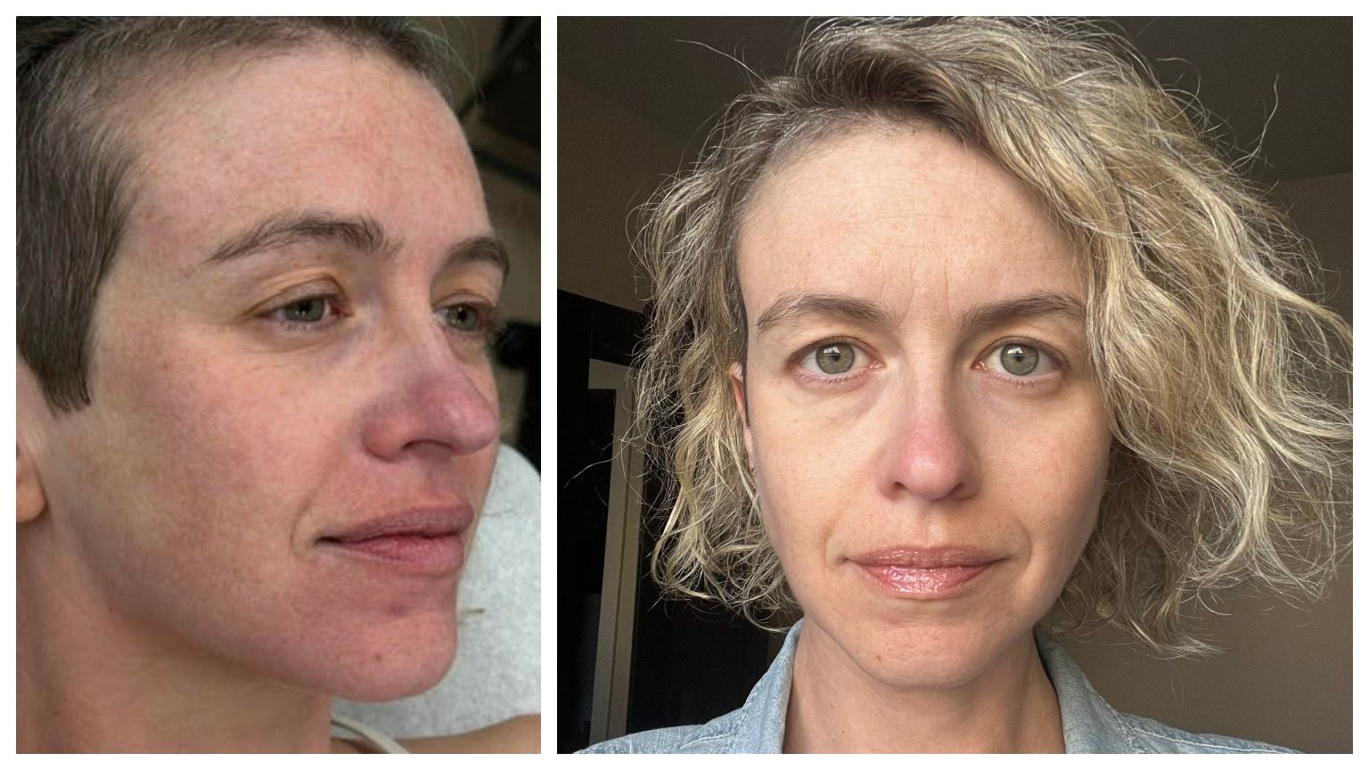 Laser Stacking for Better Skin: I Tried BBL and Halo Treatments | Marie ...