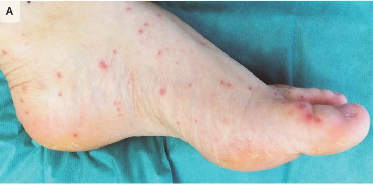 Case of 'Rat Bite Fever' Reminds Us That Even Pet Rats Carry Loads of ...