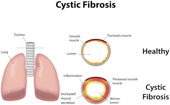 Cystic Fibrosis: Causes, Symptoms and Treatment | Live Science