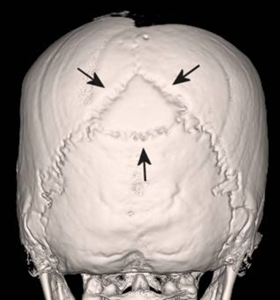 In Images: The Mummy of A Murdered Incan Woman | Live Science