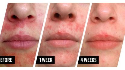 Can IUDs Give You Acne - How IUDs Affect Hormones and Skin | Marie Claire