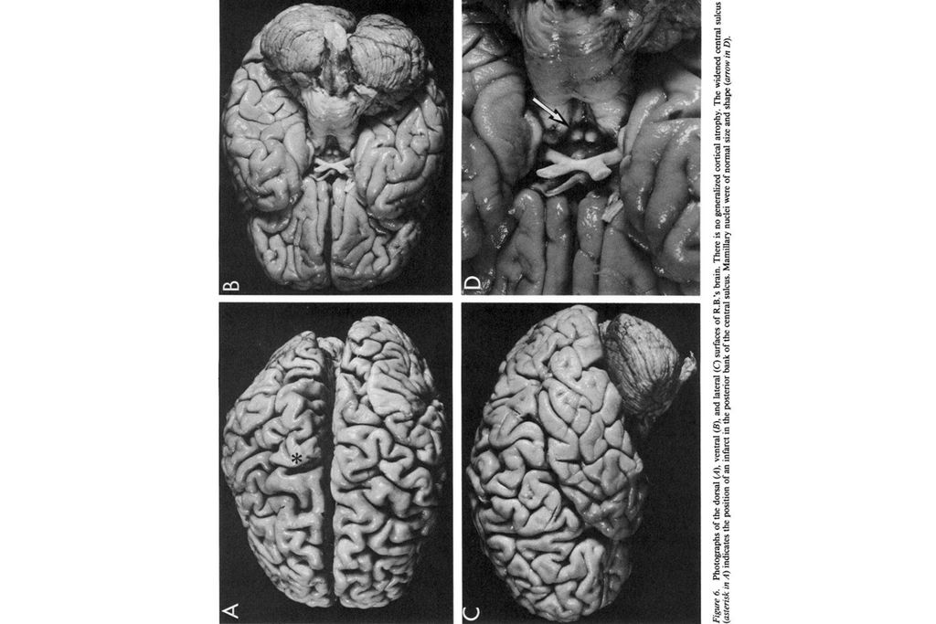 Forget Me Not: History's 17 Most Bizarre Amnesia Cases | Live Science