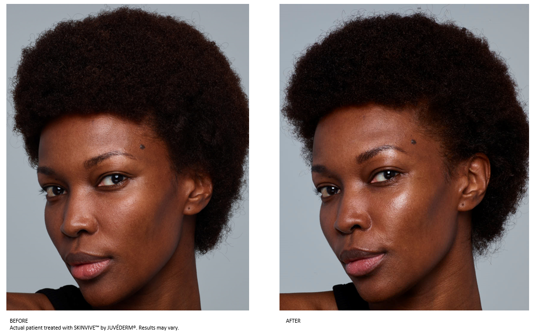 The Newest FDA-Approved Injectable, SKINVIVE, Is Unlike Anything on the ...