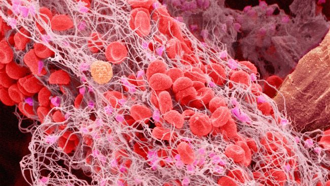 What causes blood clots? | Live Science