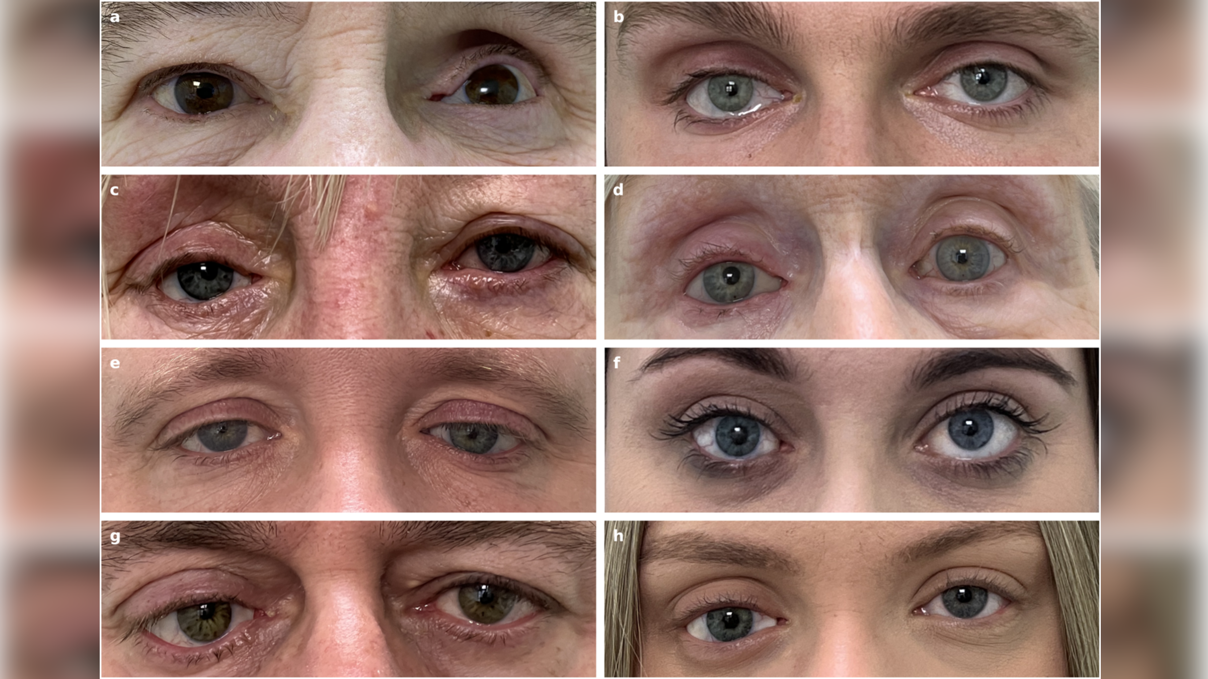 Super-realistic prosthetic eyes made in record time with 3D printing ...