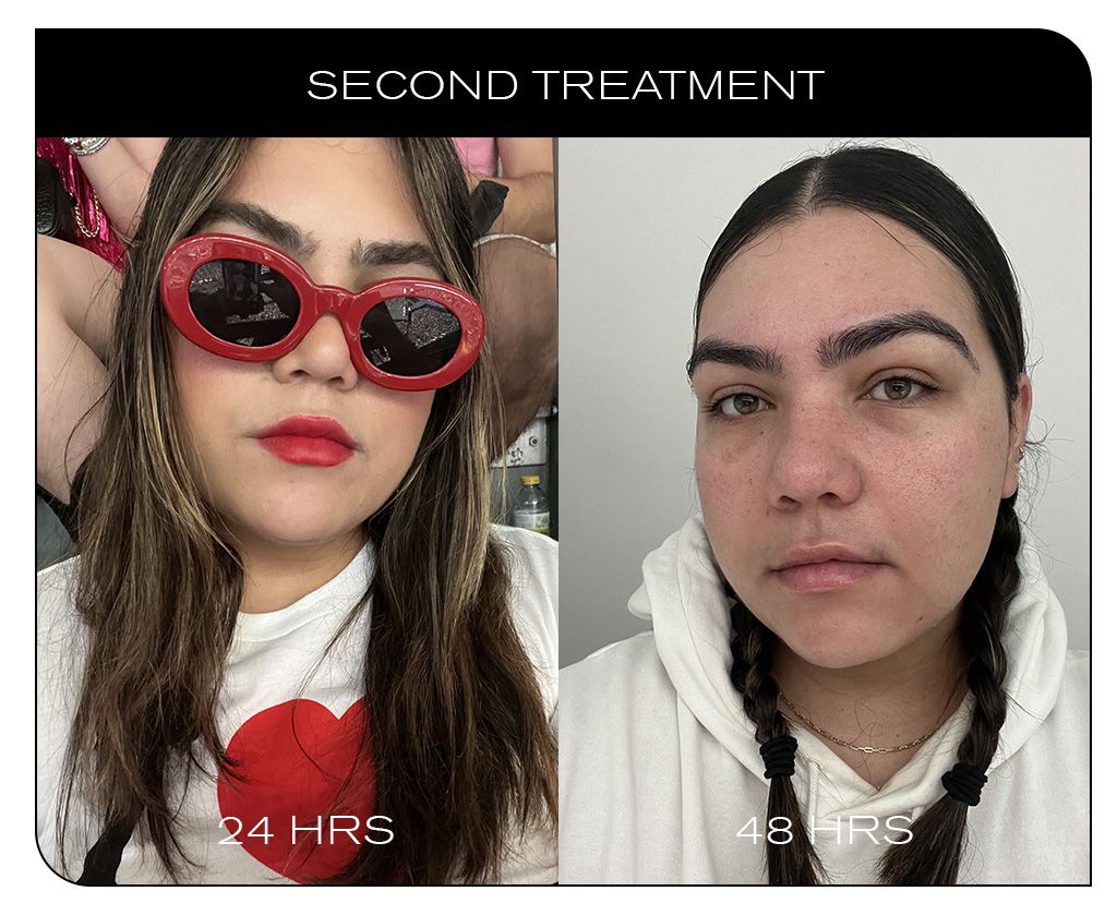Lip Filler Dissolver: What It Is and What to Expect | Who What Wear