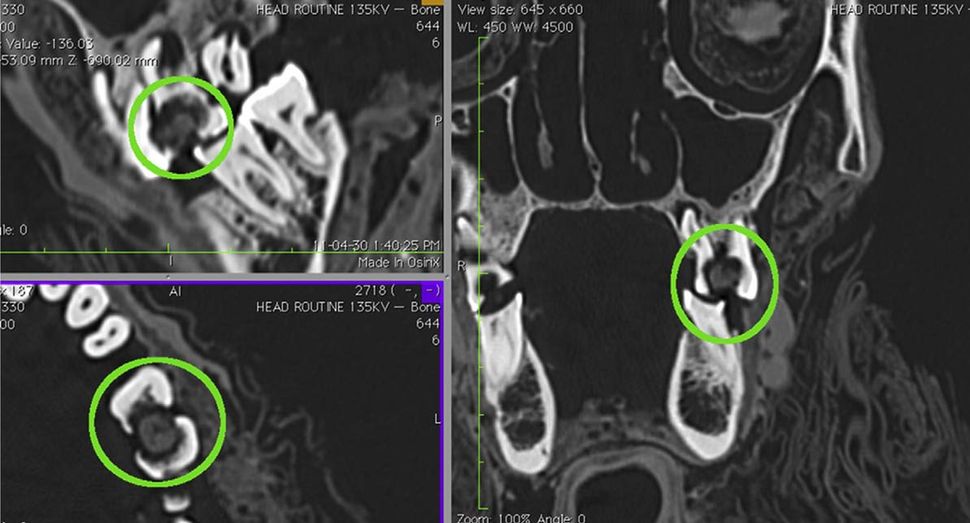 Mummy with Mouthful of Cavities Discovered | Live Science