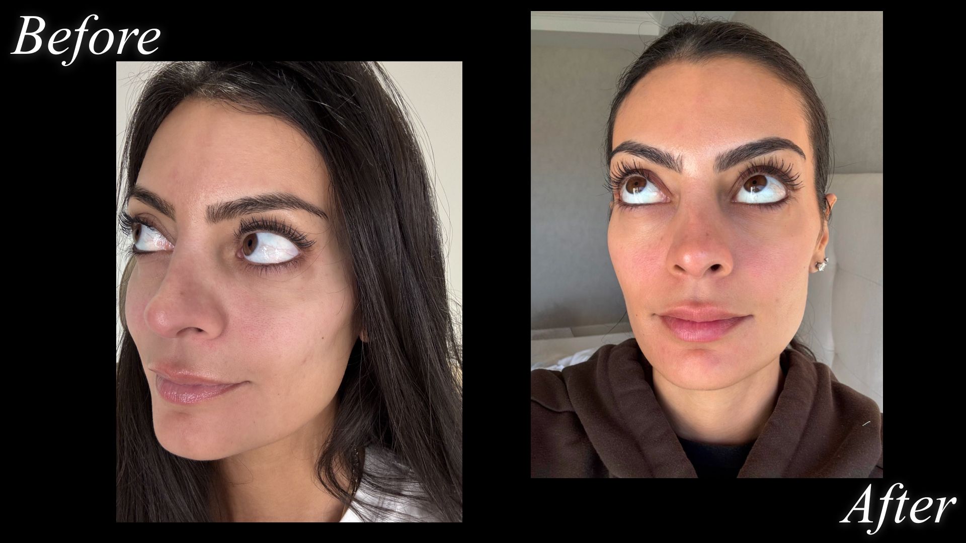 PRFM Undereye Injections: Review and Before/After Photos | Marie Claire