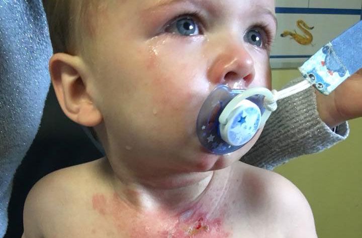 Mum's warning after son burns himself with hot drink - what you should ...