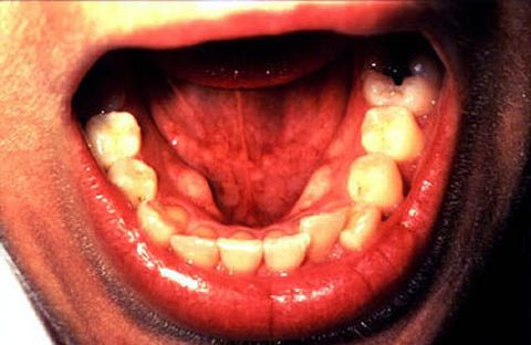 Bad Breath: Causes and Treatment | Live Science