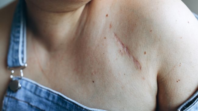 Why are scars permanent? | Live Science
