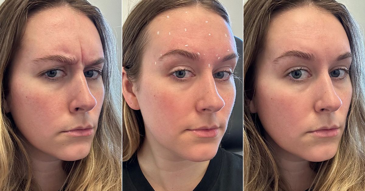 I Got Botox for the First Time—Here's What You Need to Know | Who What Wear