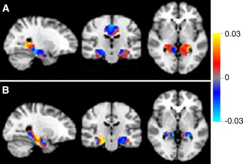 Artificial Intelligence Could Help Catch Alzheimer's Early | Live Science