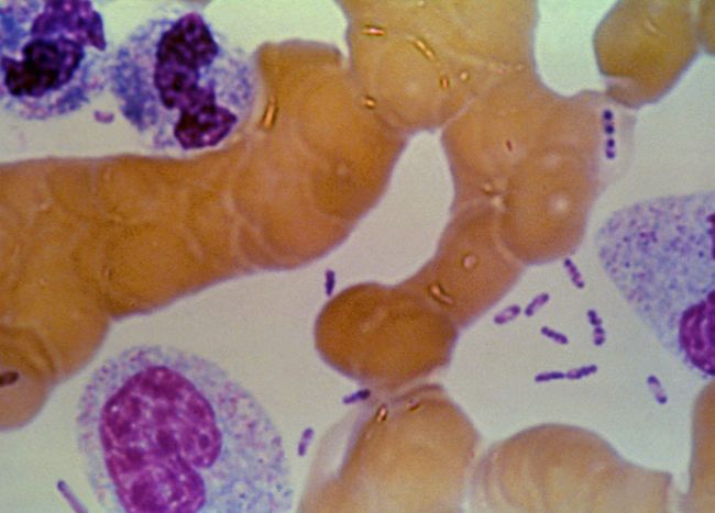 Pictures of a killer: A plague gallery | Live Science