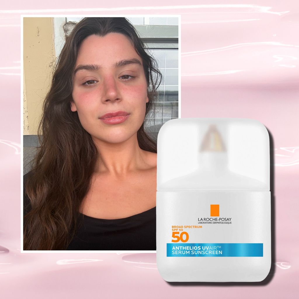 Efudex Cream Removed Years of My Sun Damage: Review | Marie Claire