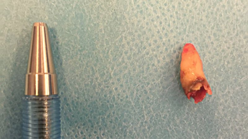 A Man's Trouble Smelling Was Caused By a Tooth Growing in His Nose ...