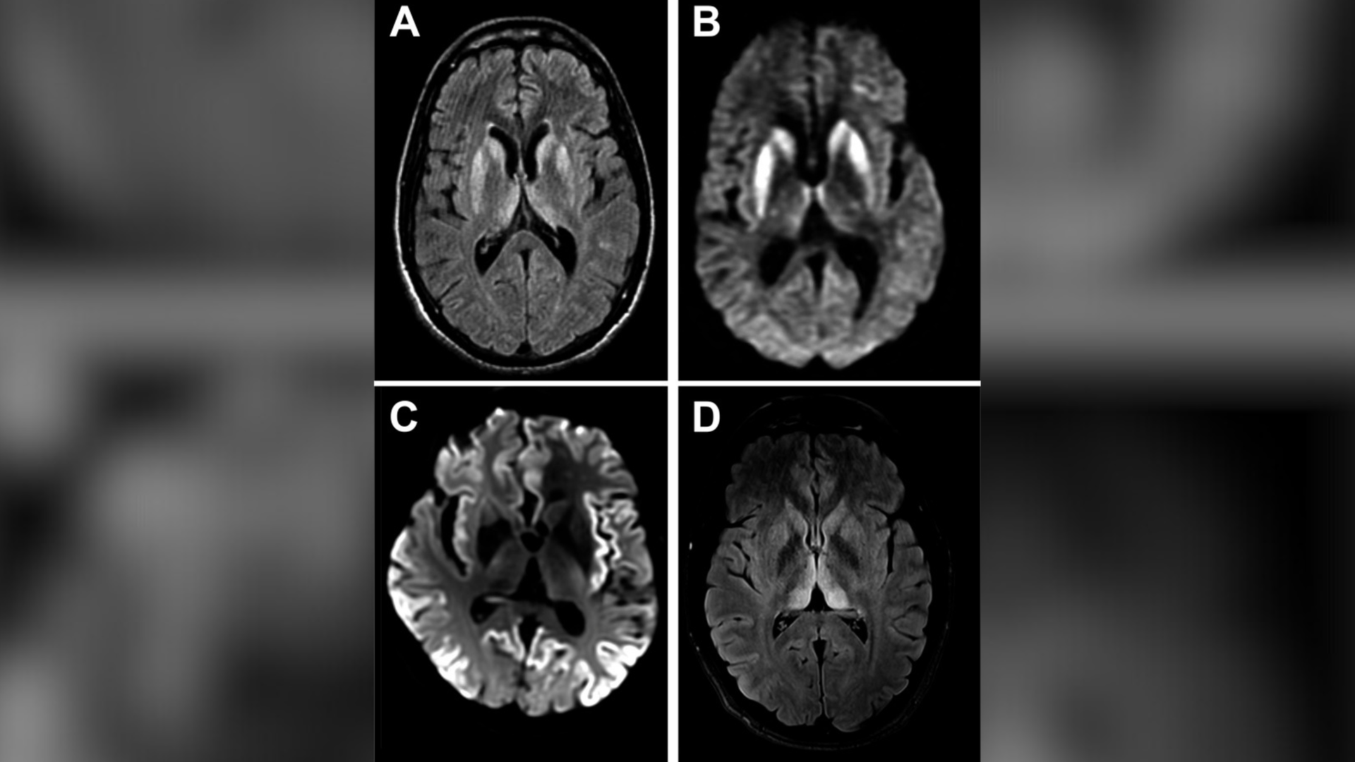 The exceptionally rare disease that causes holes to form in your brain ...