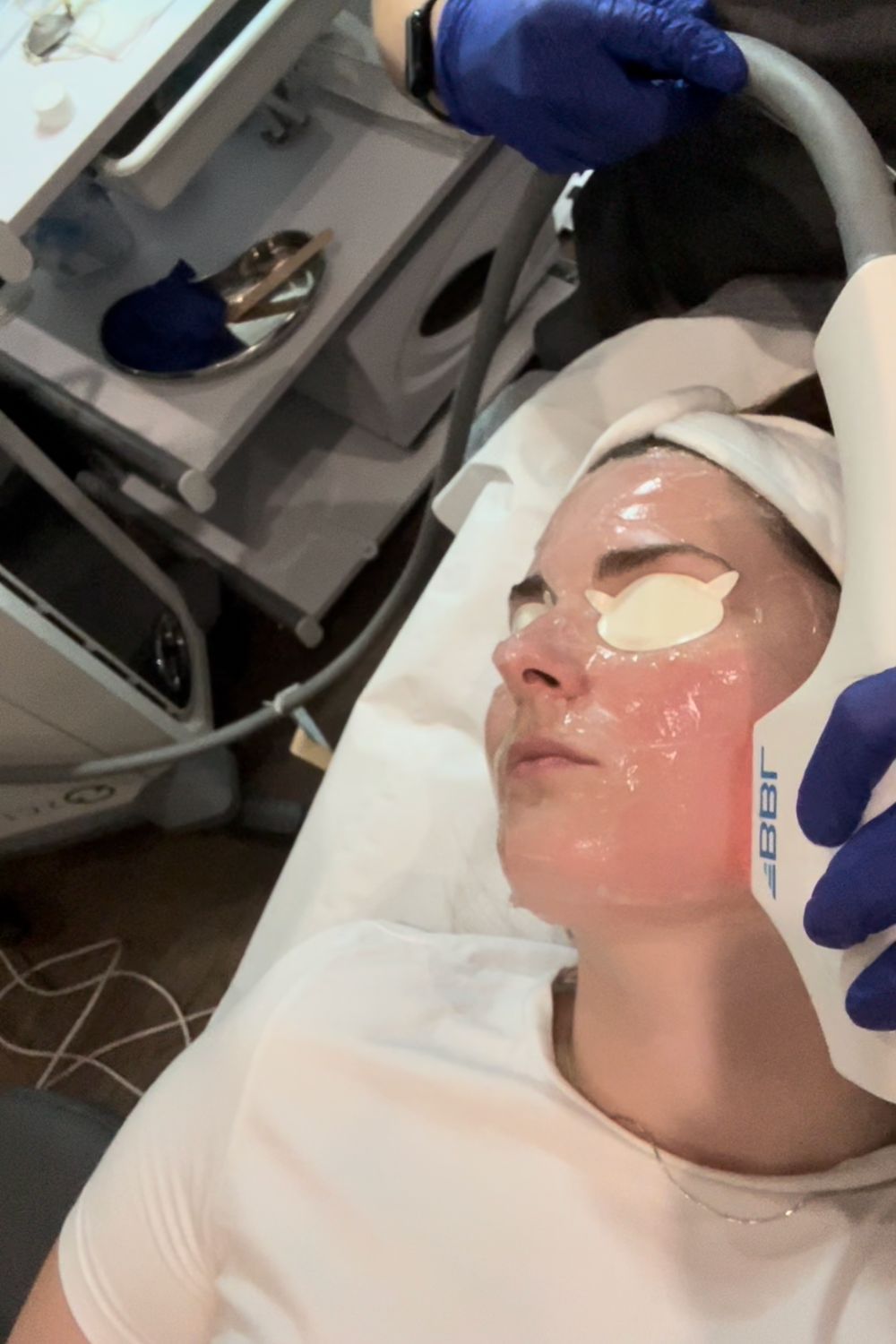 BBL Treatment, Reviewed By A Redness-Prone Editor | Marie Claire UK