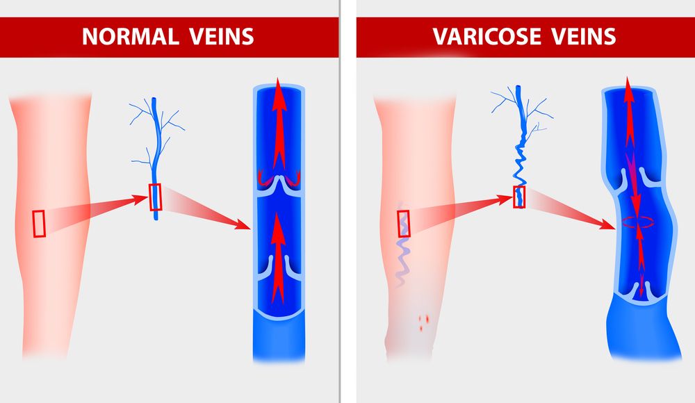 Varicose Veins & Spider Veins: Causes & Treatment | Live Science
