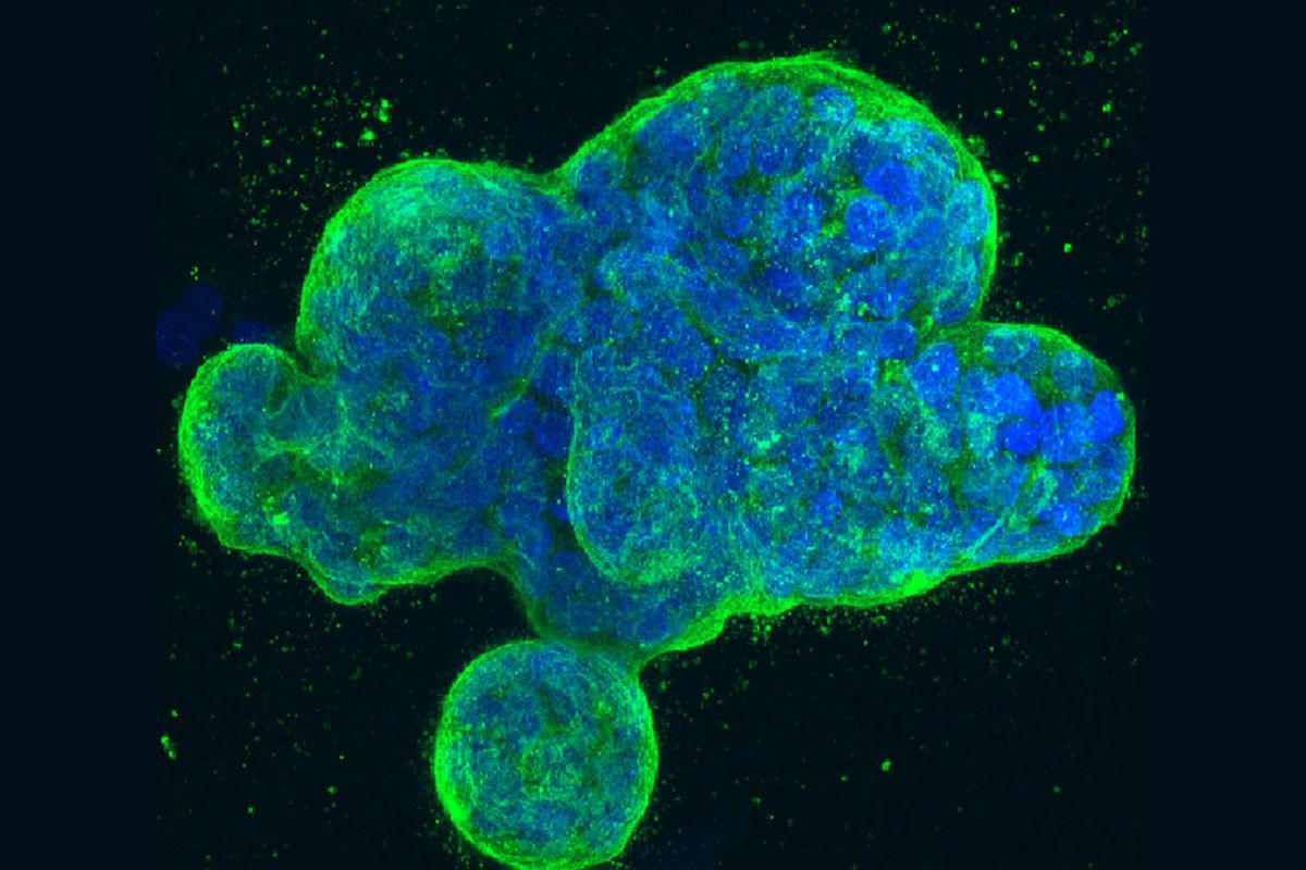 Cancer: Facts about the diseases that cause out-of-control cell growth ...