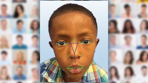 Facial recognition technology is being used to diagnose rare diseases ...