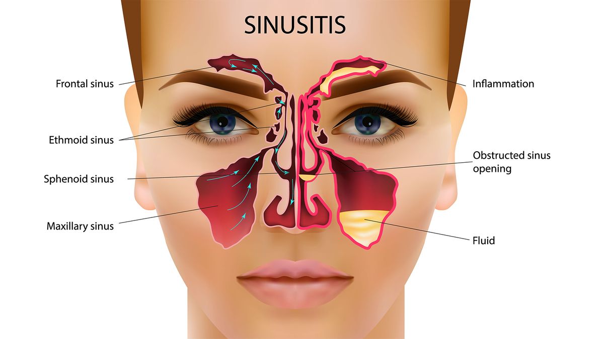 What does it look like when your sinuses are clogged? | Live Science