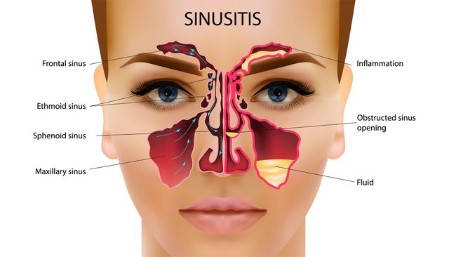 What does it look like when your sinuses are clogged? | Live Science