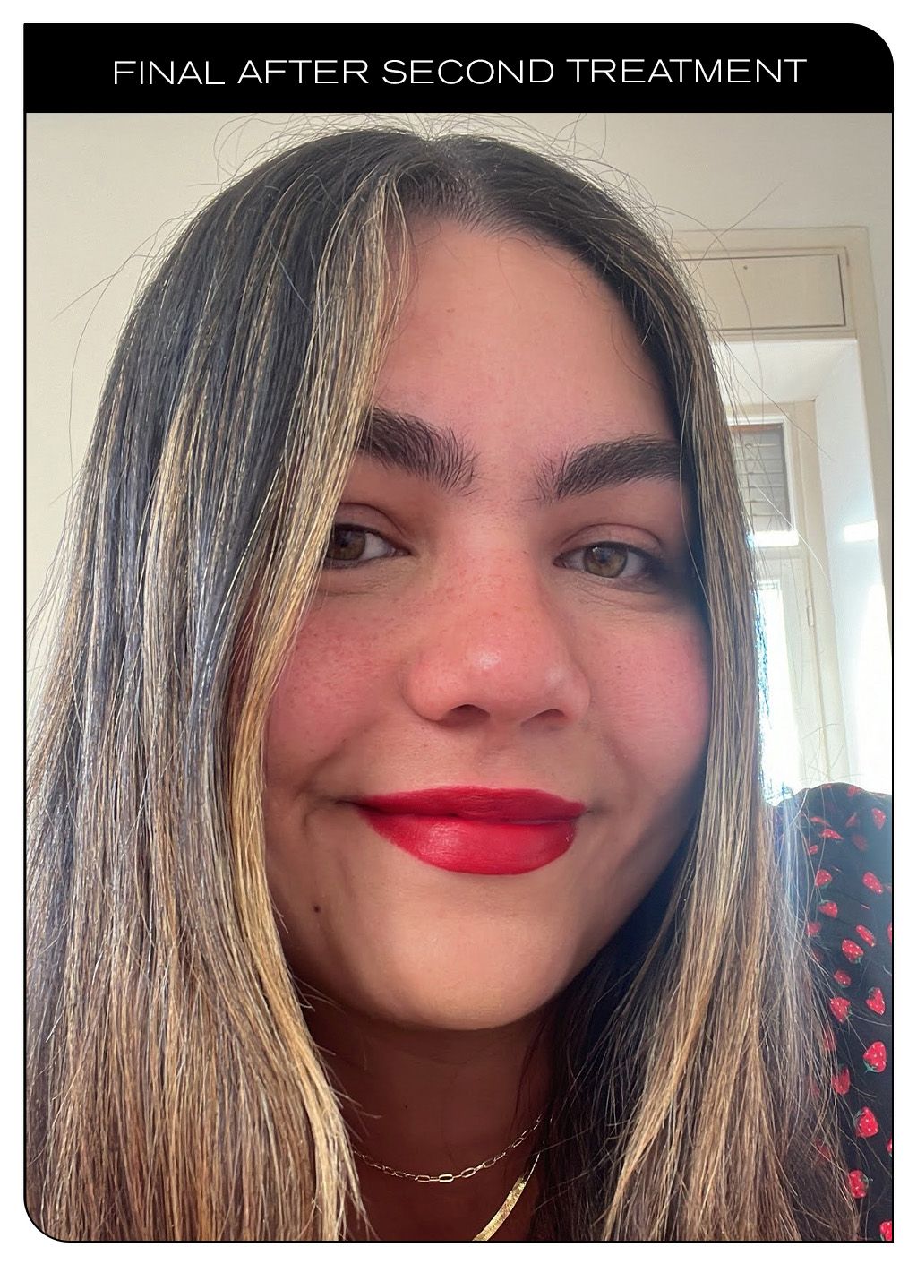 Lip Filler Dissolver: What It Is and What to Expect | Who What Wear