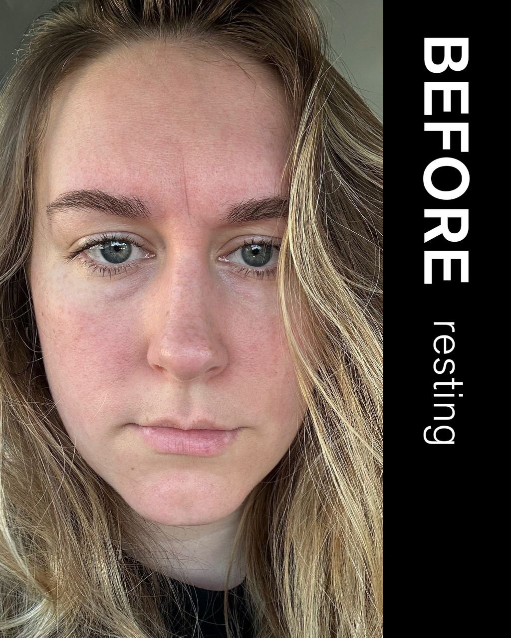 I Got Botox for the First Time—Here's What You Need to Know | Who What Wear