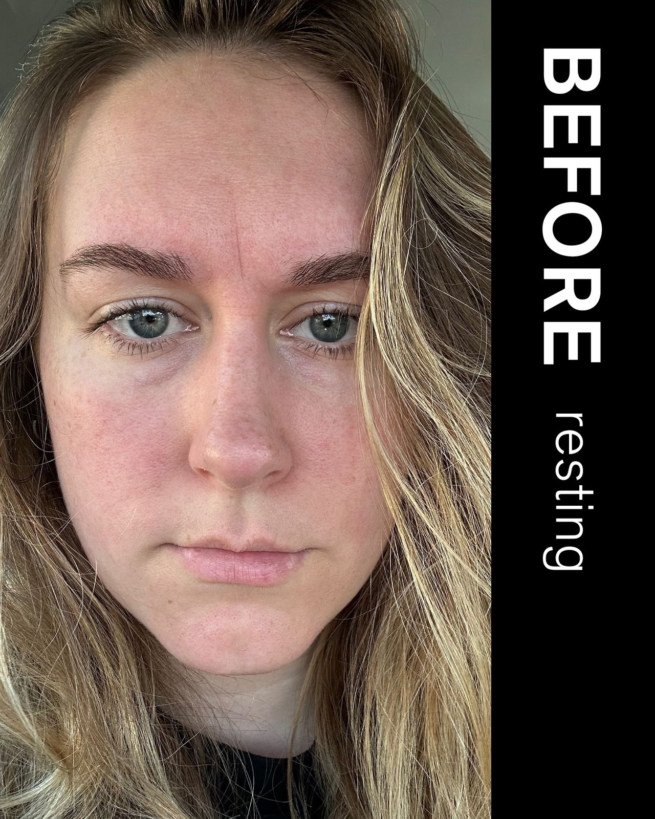 I Got Botox for the First Time—Here's What You Need to Know | Who What Wear