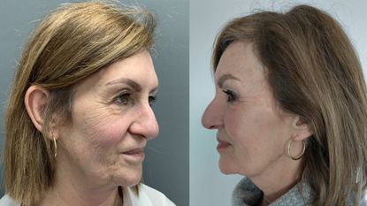 An honest Profhilo review with before and after pictures | Woman & Home