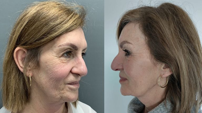 An honest Profhilo review with before and after pictures | Woman & Home